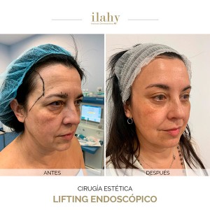 ¿Qué es el endolifting? | Ilahy Clínicas de Estética